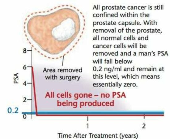 PSA Test to Determine Cure | Georgia Radiation Therapy